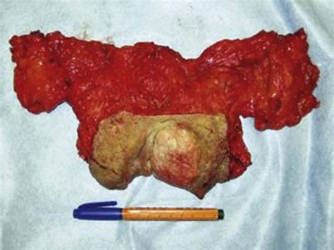 Radical Vulvectomy With Tunnel Groin Dissection Clinical Gate