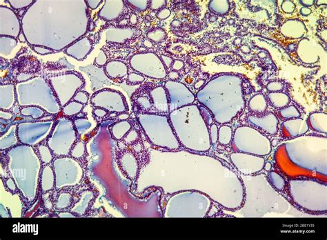 Goiter With Colloid Thyroid Disease X Stock Photo Alamy