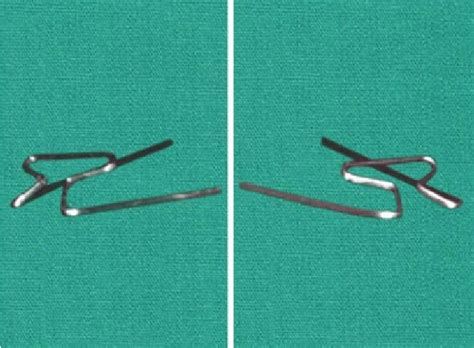 Antirotation Bends Of 35° In Each Leg Of The T Loops Download Antirotation Bends Of 35° In Each Leg Of The T Loops Download
