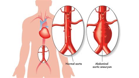 Abdominal Aort Anevrizması Eczacılar Burada Platformu