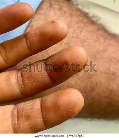 Osler Nodes Endocarditis