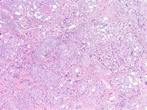 Virtual Grand Rounds In Dermatology 20 68 Year Old Woman With Subcutaneous Lesions
