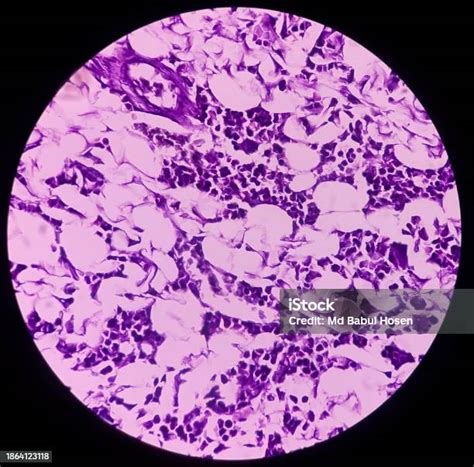 Microscopic Image Of Above Knee Amputation Section Show Fibro
