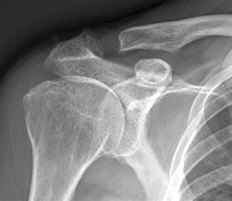 Imaging Of The Acromioclavicular Joint Anatomy Function Pathologic