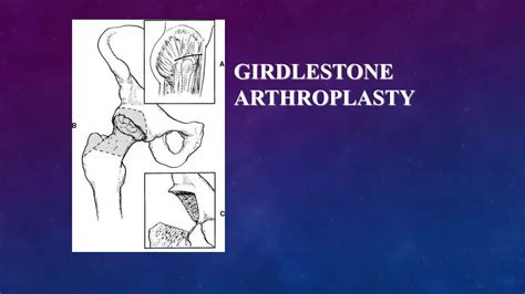 Hip Osteoarthrosis Pawan Pptx