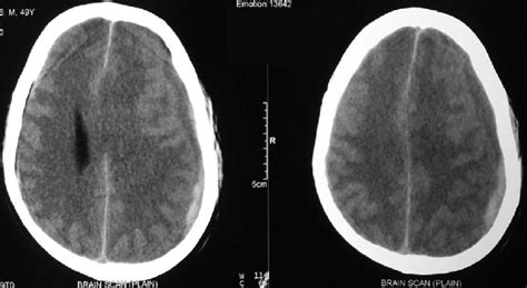 Left Frontotemporoparietal Iso To Hyperdense Subacute Subdural Hematoma Download Scientific