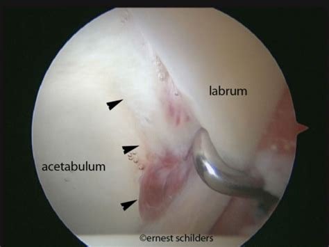 Labral Tear Hip