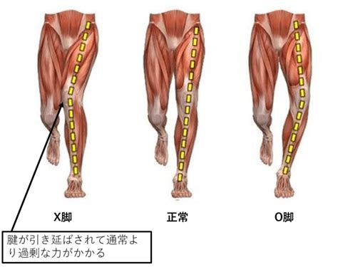 鵞足付着部滑液包炎 膝の整形外科医 学びの部屋