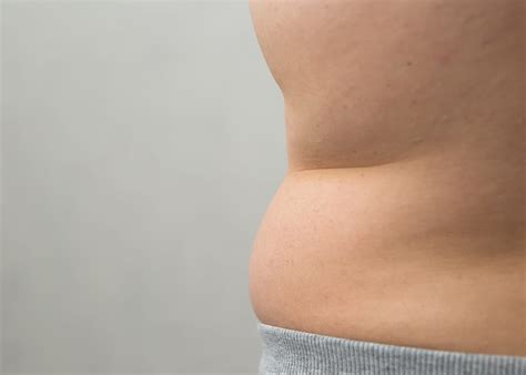 Excess Fat And Skin Excess Fat Excess Skin Anca Breahna