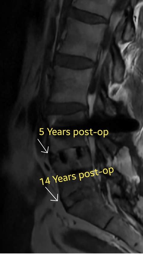 How Spinal Fusion Bone Development Can Look Over Years R Spinalfusion