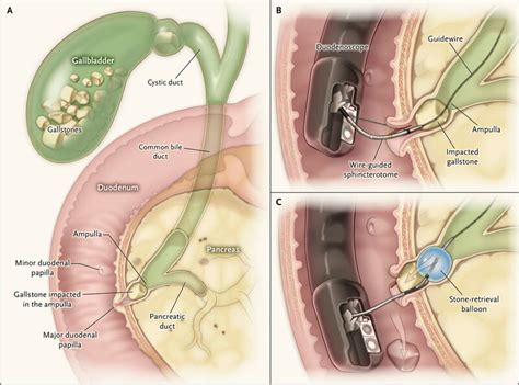 Ercp Endoscopic Retrograde Cholangiopancreatography