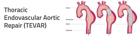 Evar And Tevar For Aortic Dissection Aneurysm Ahmedabad