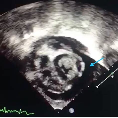 Echocardiogram Subcostal Short Axis At The Level Of The Papillary