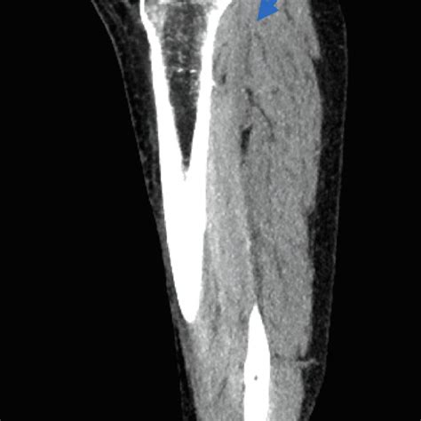 Doppler Waveforms Ankle Brachial Indices Abis And Toe Pressures