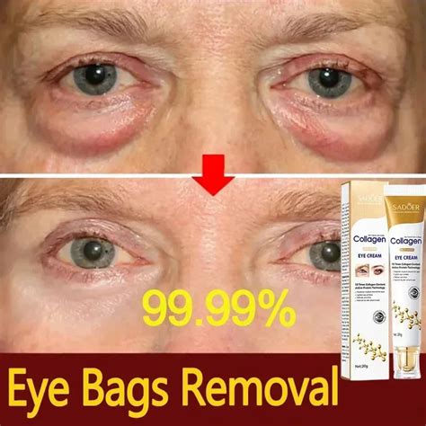 Eye Bag Removal Cream Fast Acting Health Store 1