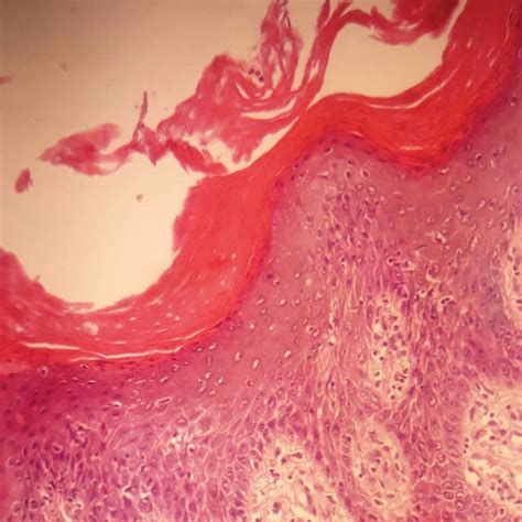 Hyperkeratosis Slight Intercellular Edema Epidermal Hyperplasia And