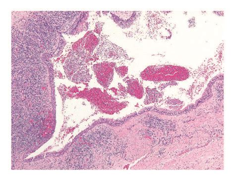 Residual Cyst Histology