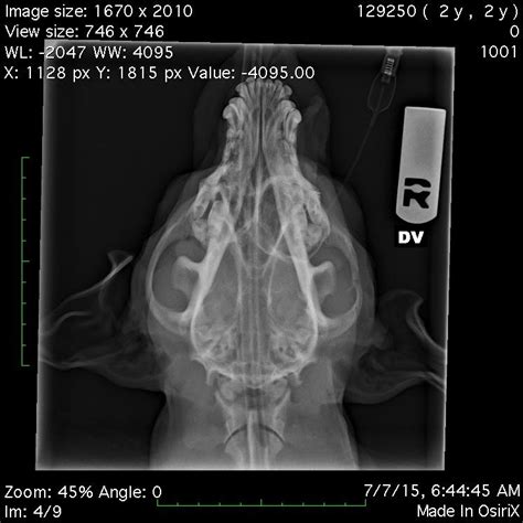 Skull Sterile Abscess