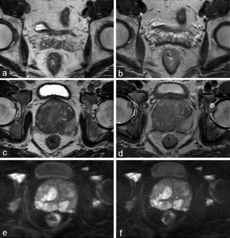 The Applied Research Of Simultaneous Image Acquisition Of T2 Weighted