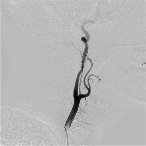 Infinix I Clinical Gallery Angiography Canon Medical Systems Usa