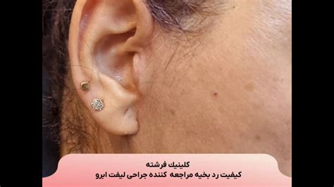 کیفیت رد بخیه کیس جراحی لیفت ابرو