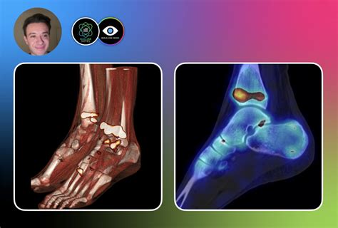 Spectct In Persistent Ankle Pain Detecting Atfl Injury And Enthesitis