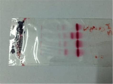 Showing Bands Of Different Haemoglobin On Cellulose Acetate Strip On
