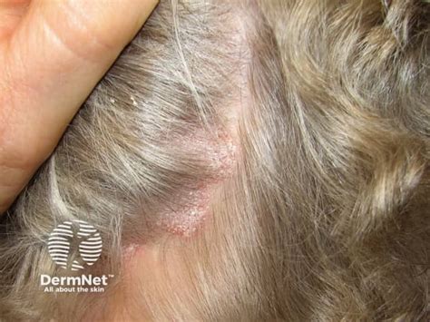 Psoriasis Of The Scalp Image