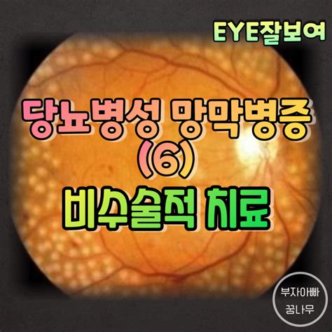 Eye잘보여 당뇨병성 망막병증 6 비수술적 치료 레이저범망막광응고술 Prp Panretianl Photocoagulation 유리체강내 약물주입술