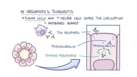 Hashimoto Thyroiditis Video Causes And Meaning Osmosis
