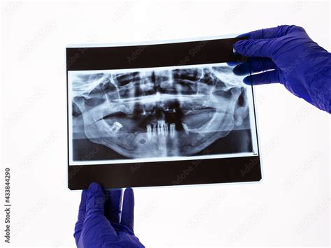 The Dentist Hands Holding The Panoramic Facial X Ray Image Of An Old