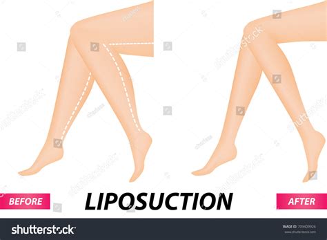 Liposuction Surgery Leg Fat Before After Stock Vector Royalty Free