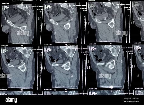 Cairo Egypt November 21 2023 Non Enhanced Ct Scan Of The Pelvis