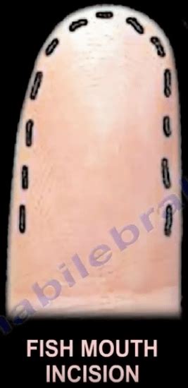 Felon Bacteria Infections Orthopedics Finger Healthcare