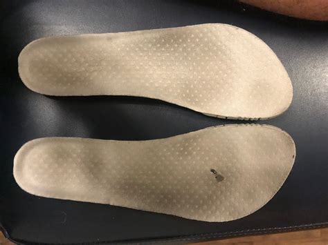 Internal Tibial Torsion Puts Pressure On The Outside Of The Foot — The