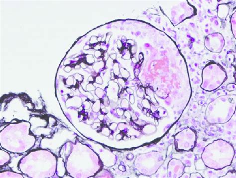 Renal Biopsy From Patient 2 Silver Stain Showing Glomerulus With
