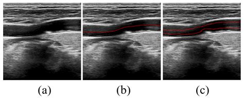 Automated Lumen Segmentation In Carotid Artery Ultrasound Images Based