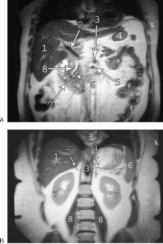 Venous Anatomy Of The Abdomen And Pelvis Radiology Key