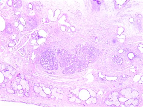 A Poorly Circumscribed Dermal Tumor Showing A Glandular And Cribriform