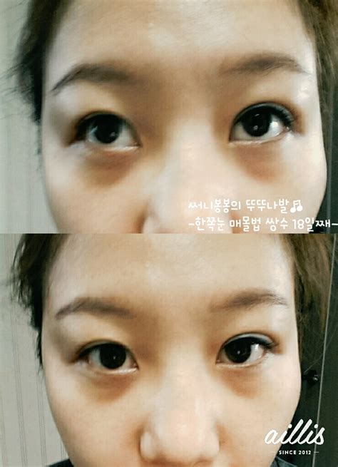 한쪽눈 매몰법 쌍커플수술 18일째~ 네이버 블로그