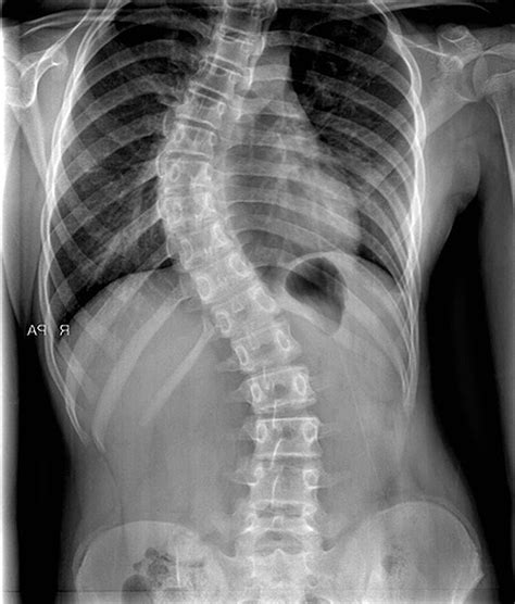 SCOLIOSIS Buyxraysonline