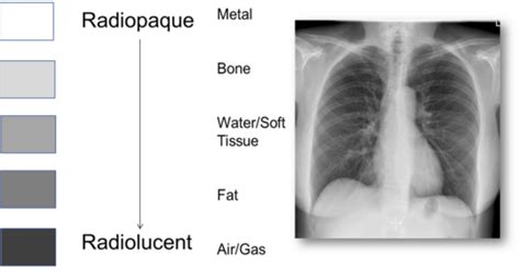 Abdominal X Ray Intro Flashcards Quizlet