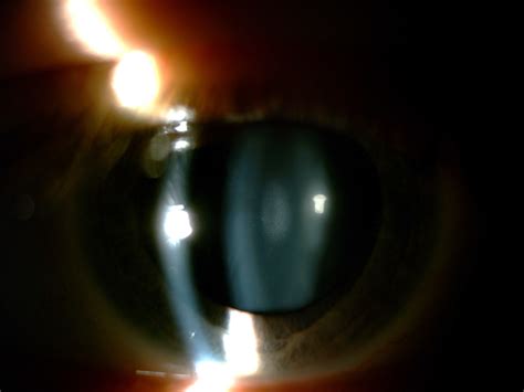 56 Questions With Answers In Cataract Science Topic