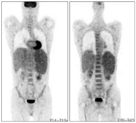Positron Emission Tomography Shows Marked Splenomegaly And Diffusely Download Scientific