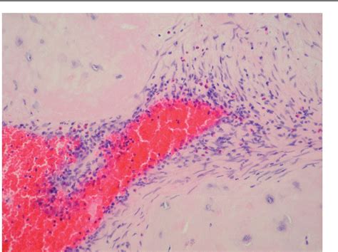 Figure 1 From Eosinophilic T Cell Chorionic Vasculitis And Intrauterine Fetal Demise At 34 Weeks