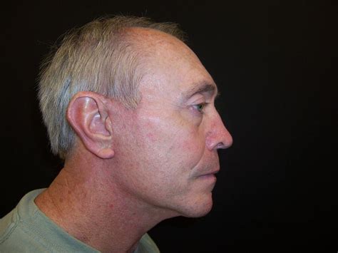 Male Facial Plastic Surgery Before And Afters Ocss