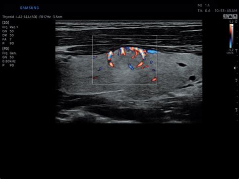 Ultrasound Images Thyroid S Flow Echogramm