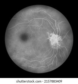 Nonproliferative Diabetic Retinopathy Illustration Showing Flameshaped Stock Illustration