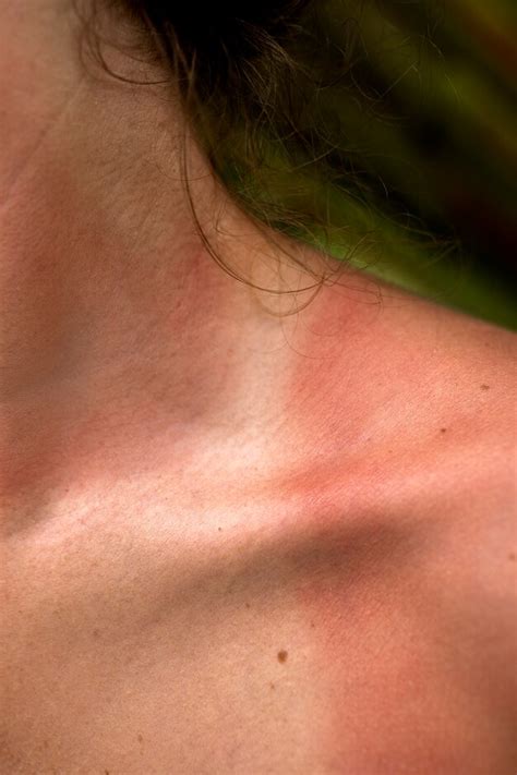 Understanding And Managing Skin Rashes Symptoms And Treatments