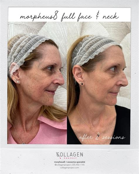 About Us — Collagen Project